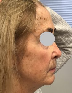 Solar Lentigo - Main Street Skin Clinic